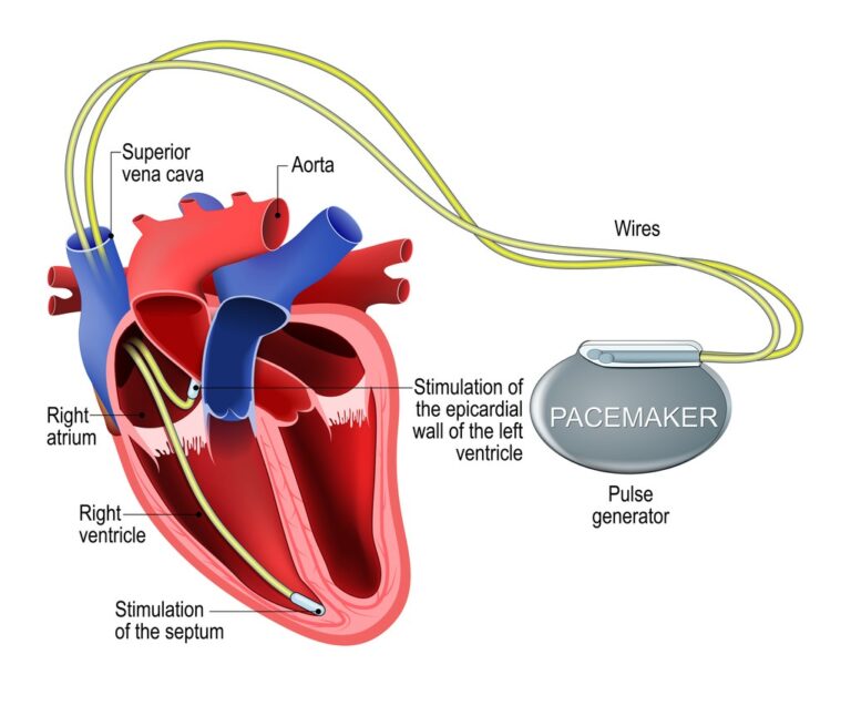 How Pacemakers Are Revolutionizing Heart Care